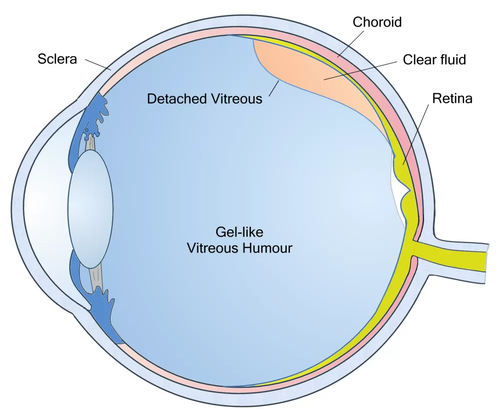 Retina and Vitreous Treatment - Shefa Modern Clinic